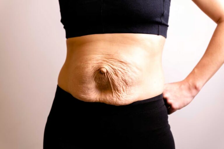 Diastasis Recti (Tummy Separation) - Blizard Physiotherapy